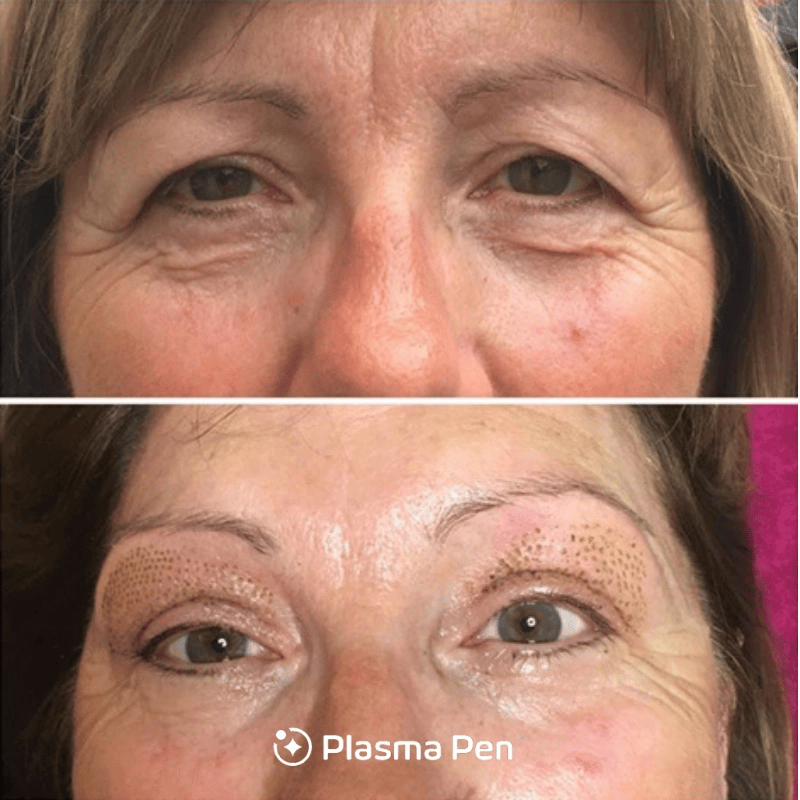 Non-Surgical Eyelid Lift for Tighter, Youthful Look - Skin Revision