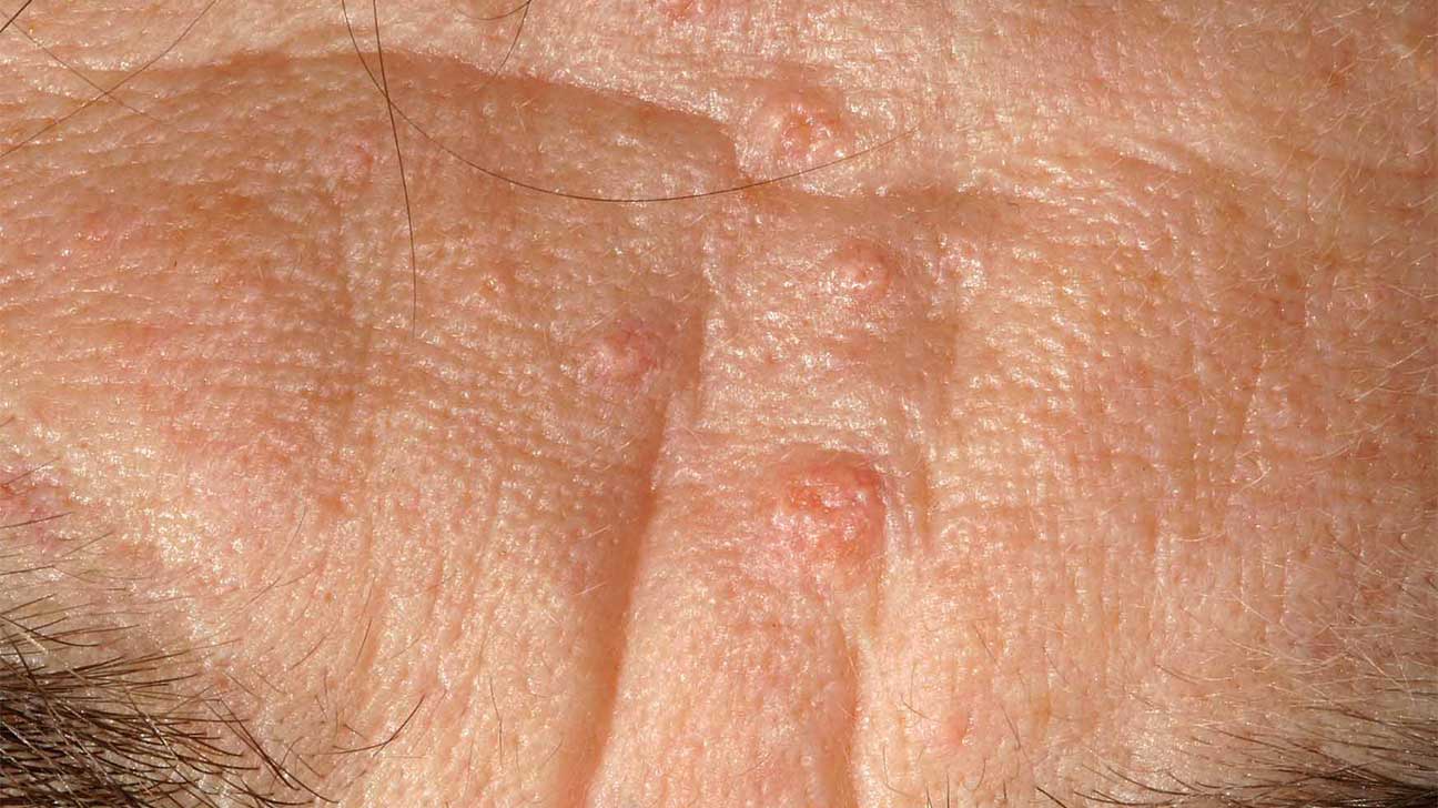 Sebaceous Hyperplasia and Cyst Removal Options - Skin Revision