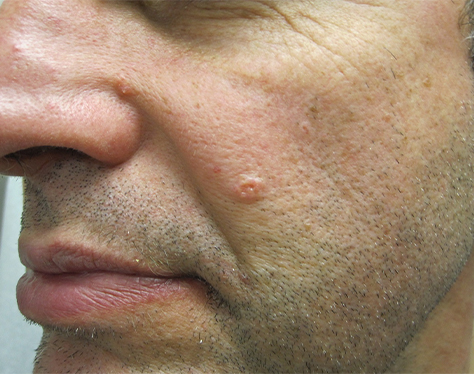 Sebaceous Hyperplasia and Cyst Removal Options - Skin Revision