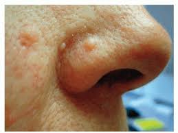 Fibrous Papule treatment- Skin Revision