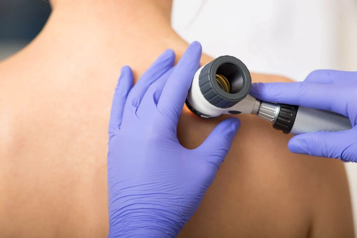 Quick Mole Check & Assessment in Beaconsfield | Skin Revision
